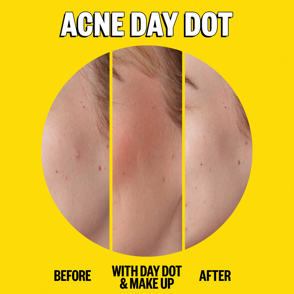 Acne Day & Night Duo | Peace Out Skincare