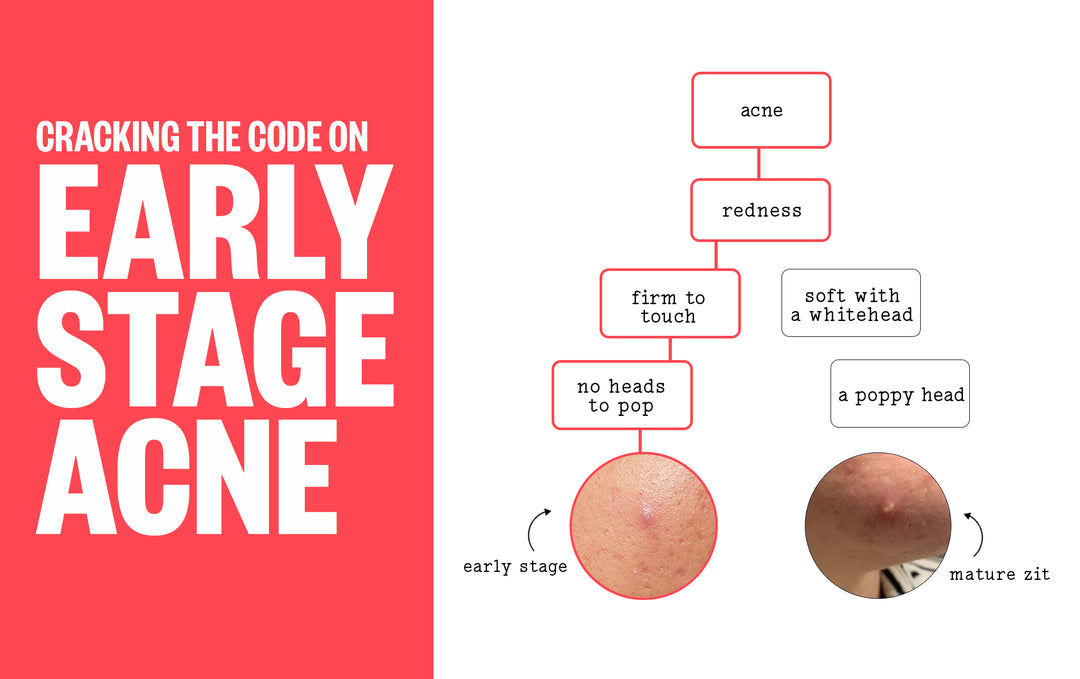 What Does Early Stage Acne Look Like? | Peace Out Skincare