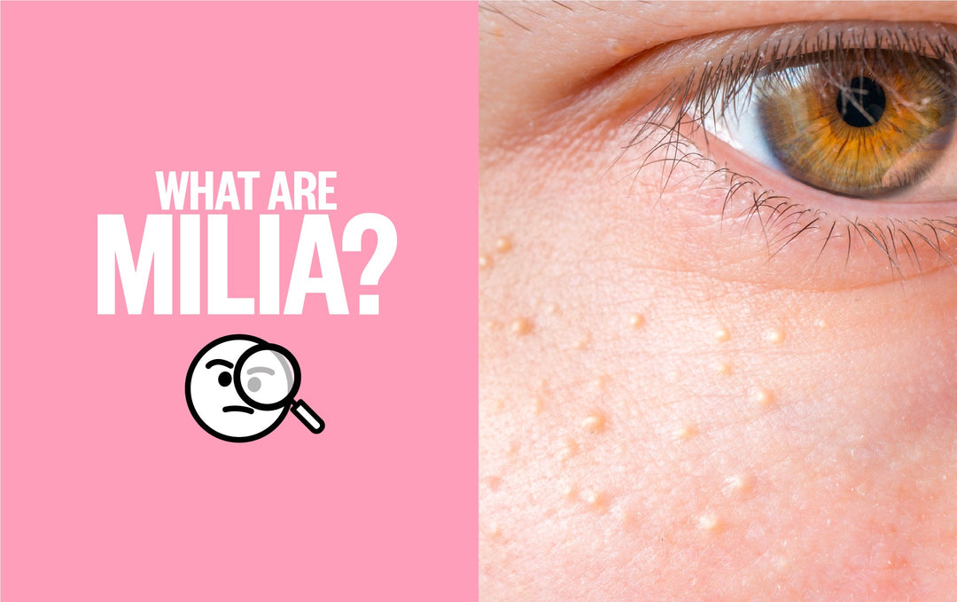 How To Treat & Prevent Milia | Peace Out Skincare