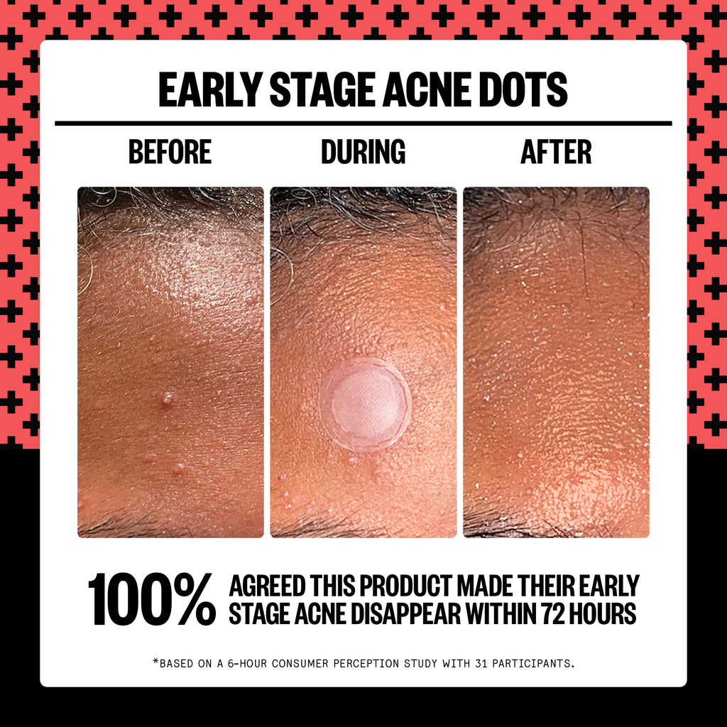 Early Stage Acne Dots | Peace Out Skincare